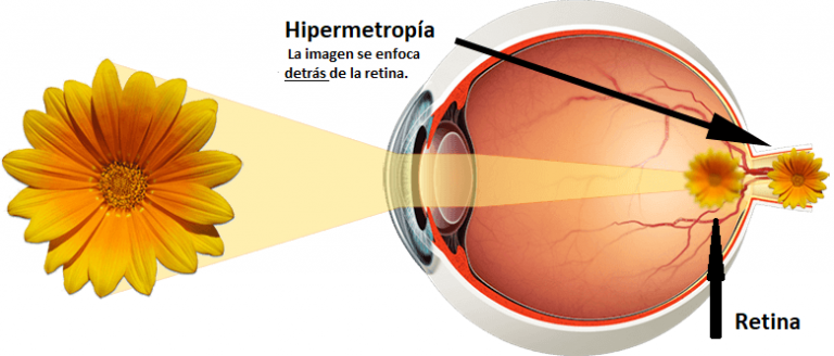 Hipermetropía Concepto Causas Tipos Síntomas Diagnóstico